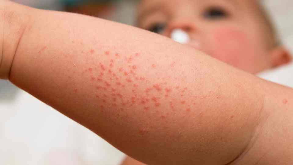 Impetigo NHS Pharmacy First Treatment - Mistrys Pharmacy